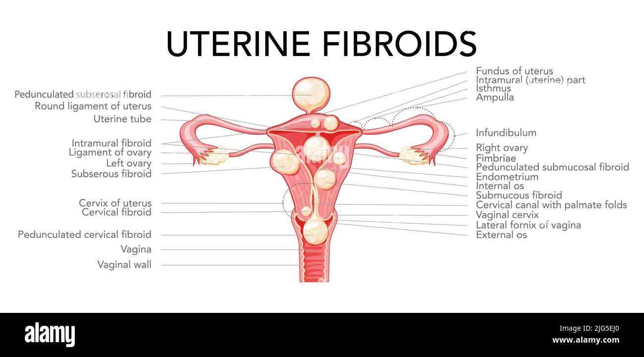 Uterine Fibroids Female Leiomyomas Reproductive System Uterus Diagram