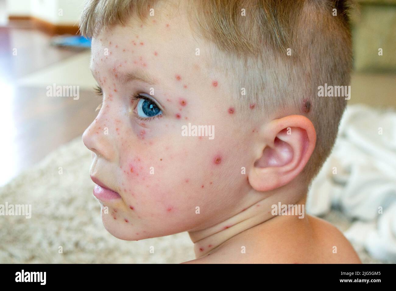 Smallpox vaccination boys hi-res stock photography and images - Alamy