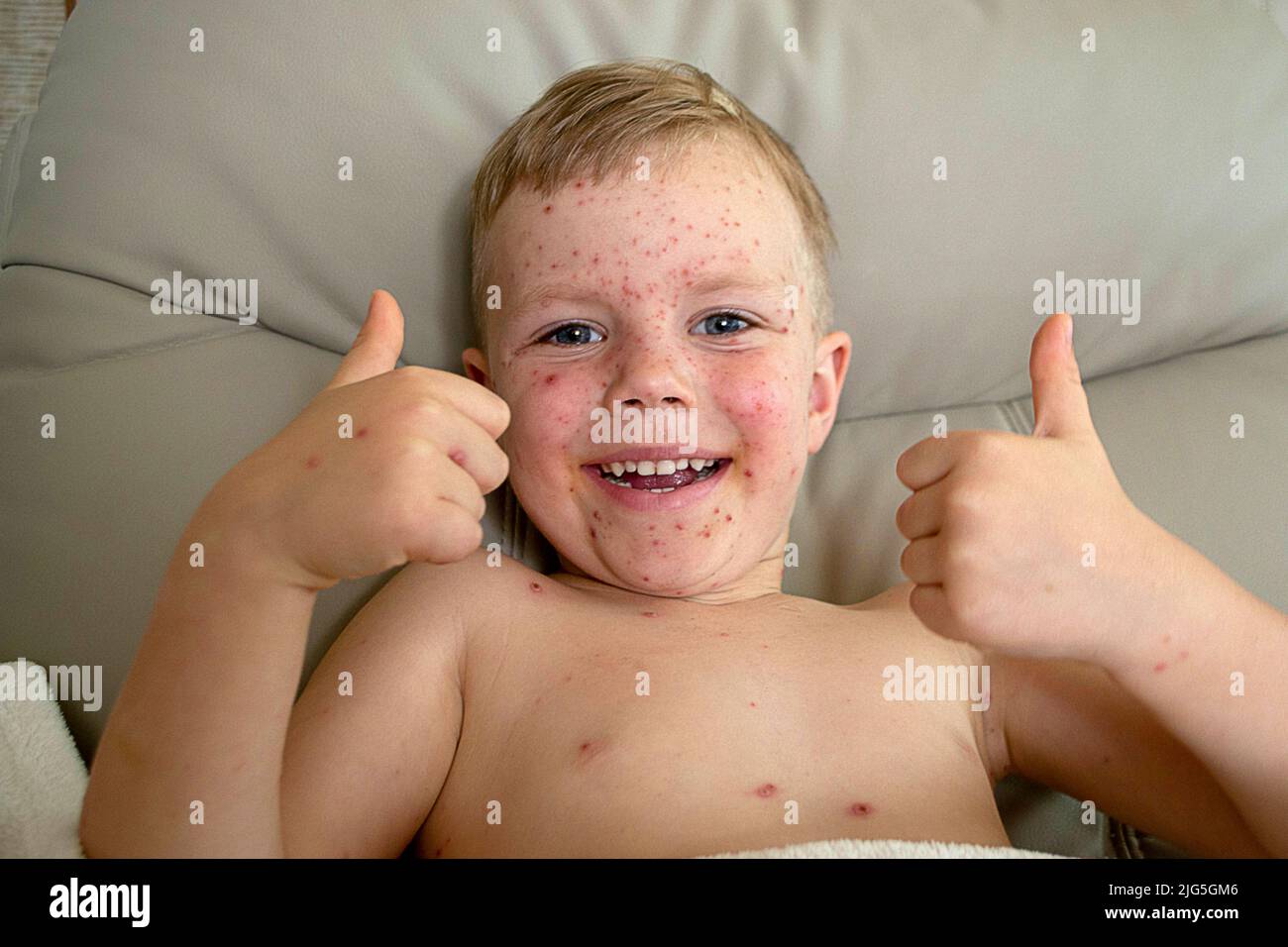 Smallpox vaccination boys hi-res stock photography and images - Alamy
