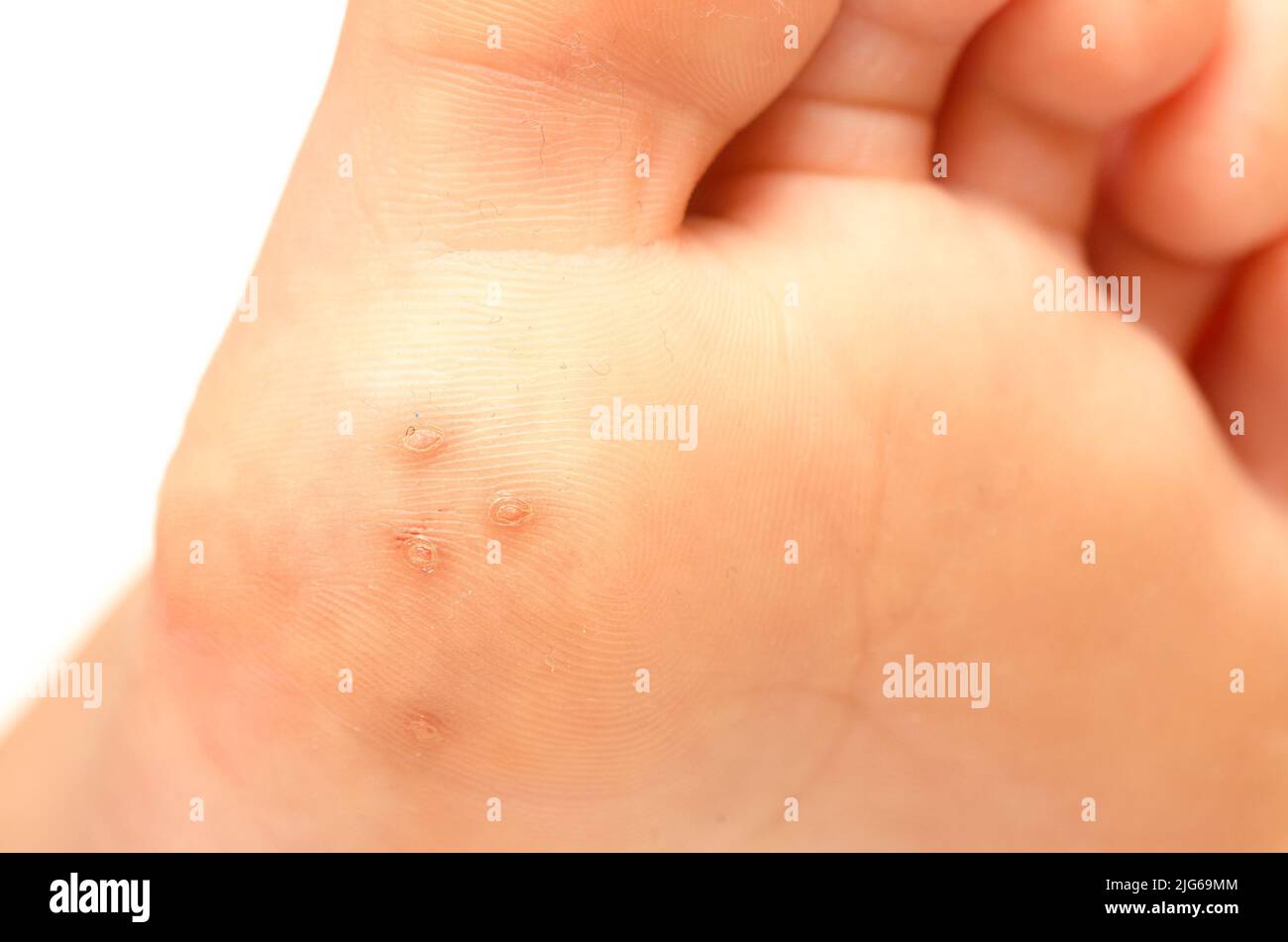 Closeup of plantar warts under foot of a child Stock Photo - Alamy