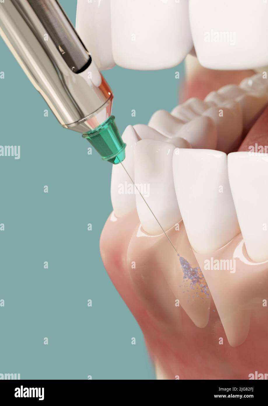 Periodontal survey and anesthesia renders Stock Photo - Alamy