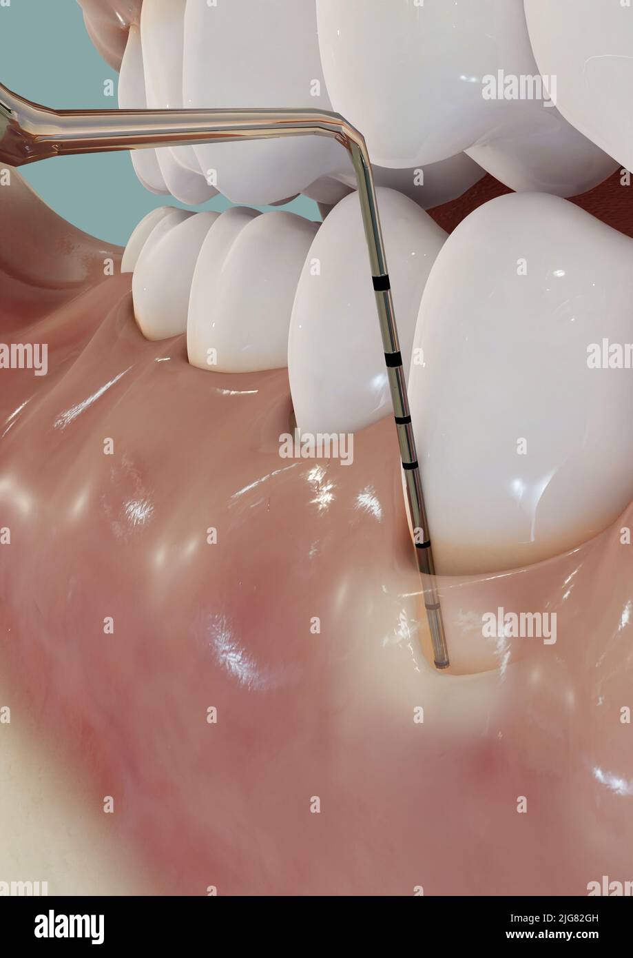 Periodontal survey and anesthesia illustration Stock Photo - Alamy