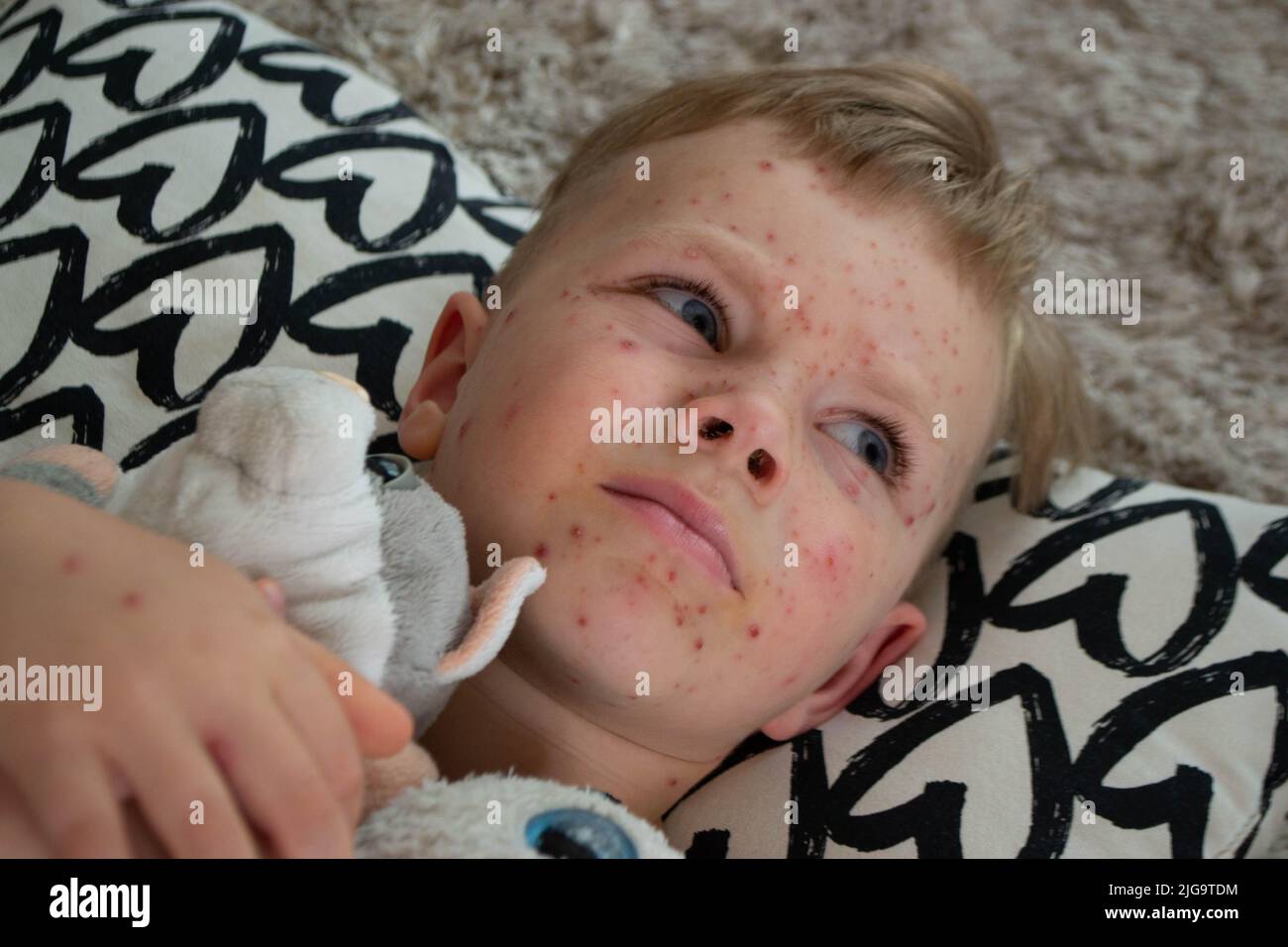 Smallpox vaccination boys hi-res stock photography and images - Alamy