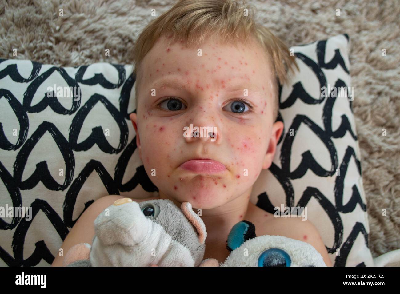 Smallpox vaccination boys hi-res stock photography and images - Alamy