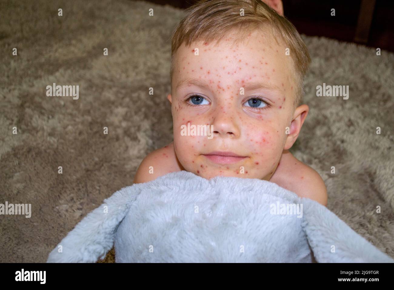 Smallpox vaccination boys hi-res stock photography and images - Alamy