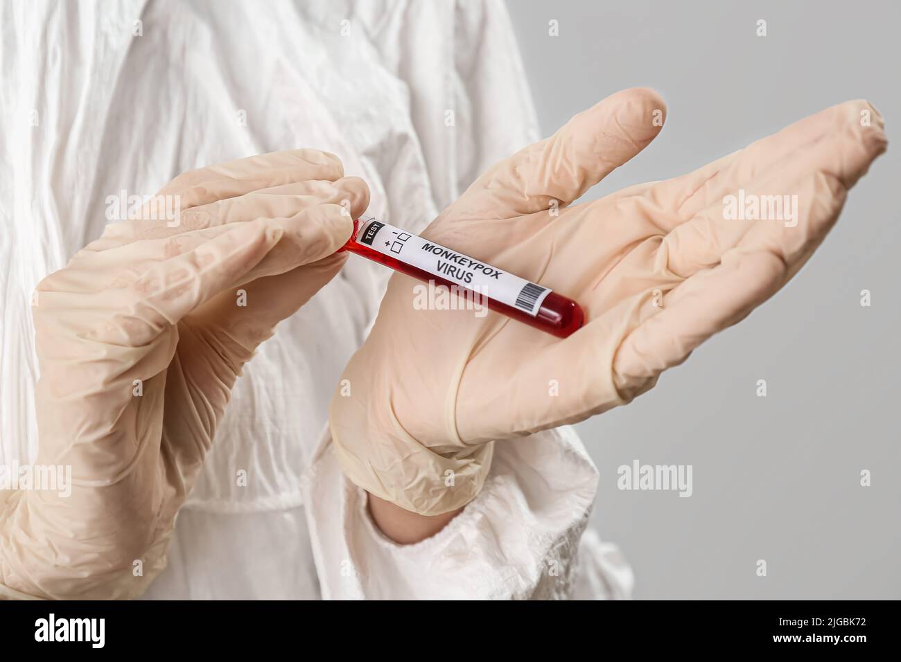 Monkeypox sample hi-res stock photography and images - Alamy