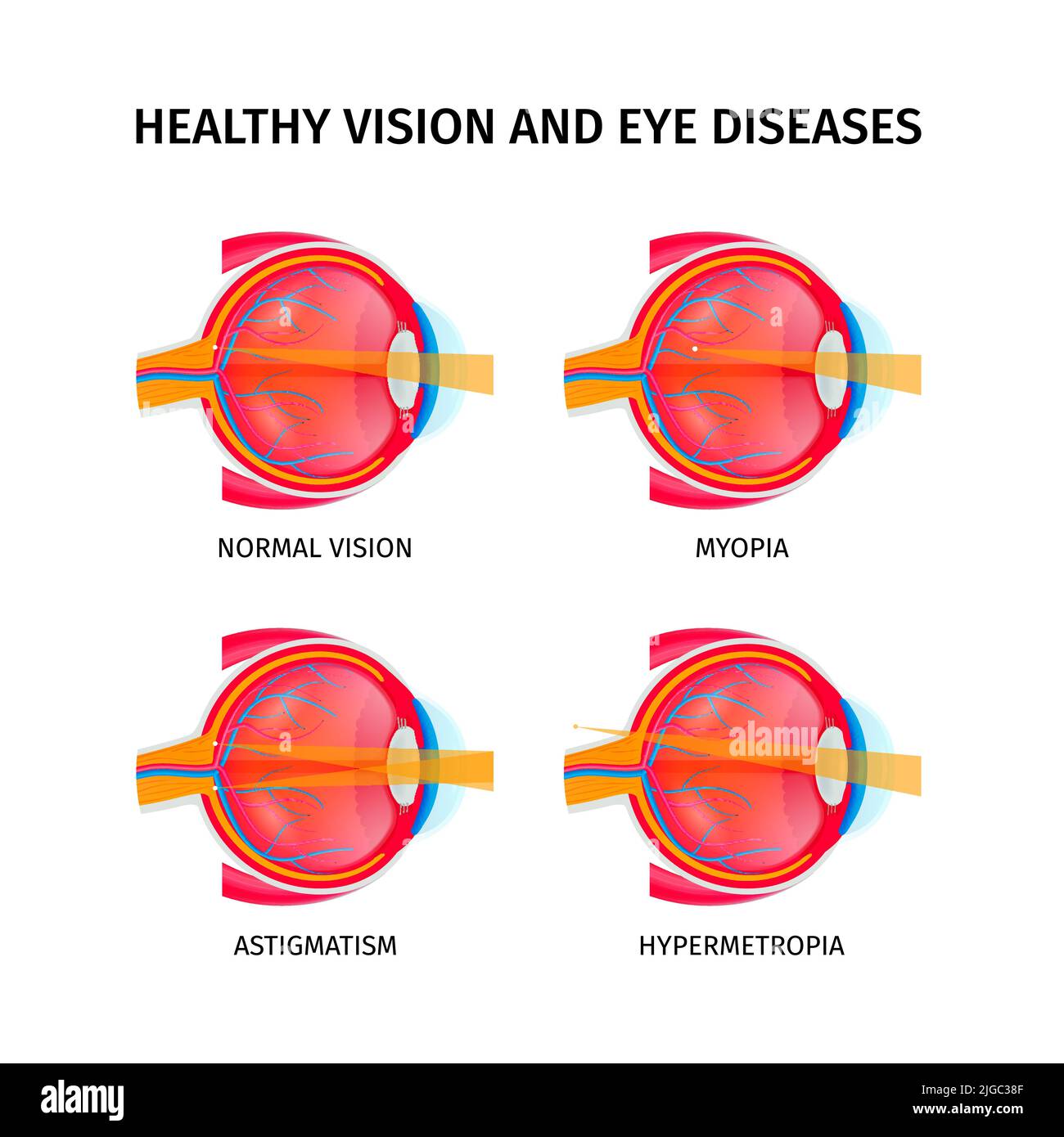 Human eye anatomy set with vision disorders symbols isometric isolated ...