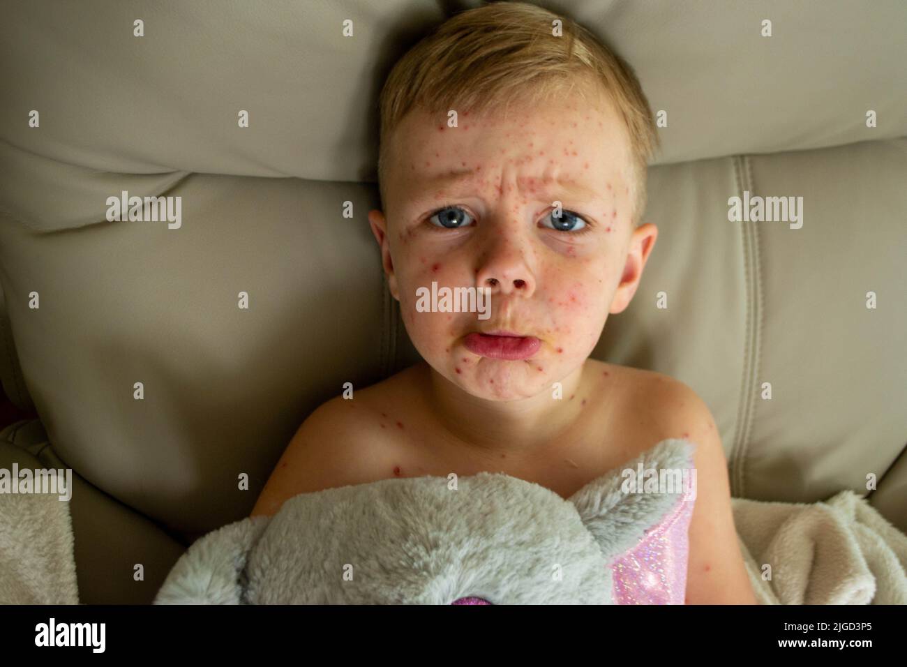 Smallpox vaccination boys hi-res stock photography and images - Alamy
