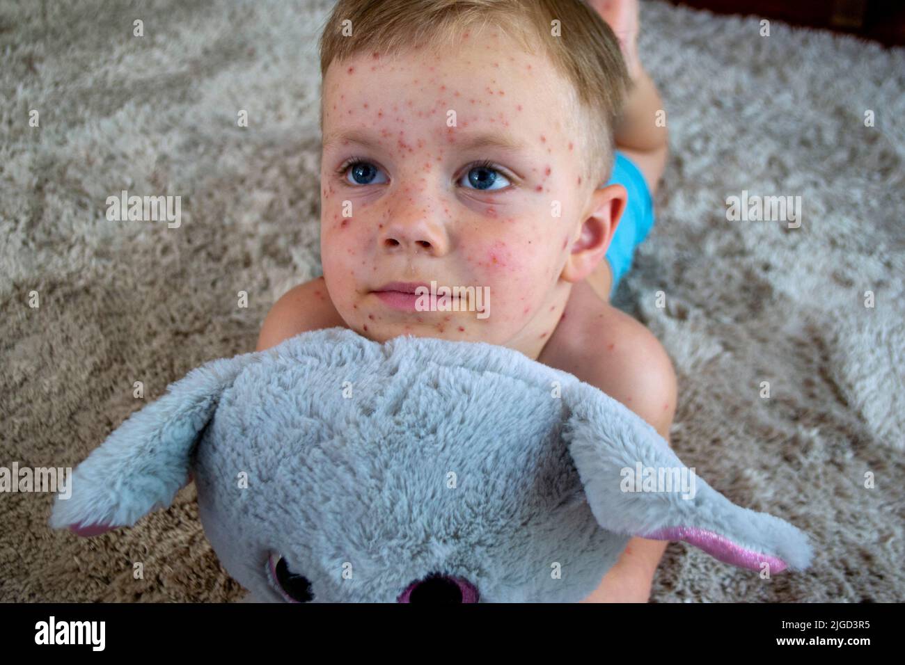 Smallpox vaccination boys hi-res stock photography and images - Alamy
