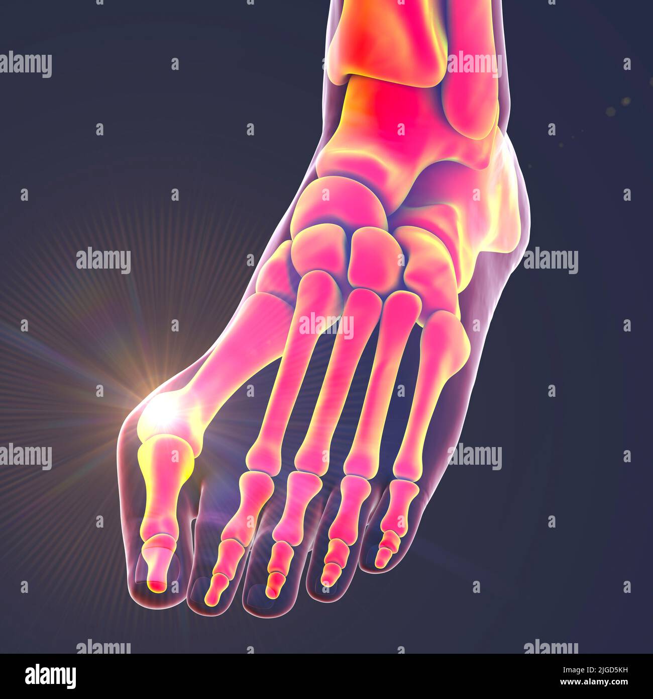 Feet deformities hi-res stock photography and images - Alamy