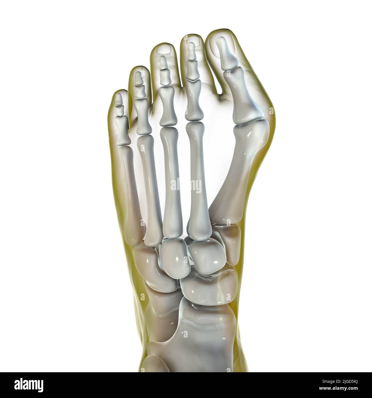 Woman deformed foot bones hi-res stock photography and images - Alamy
