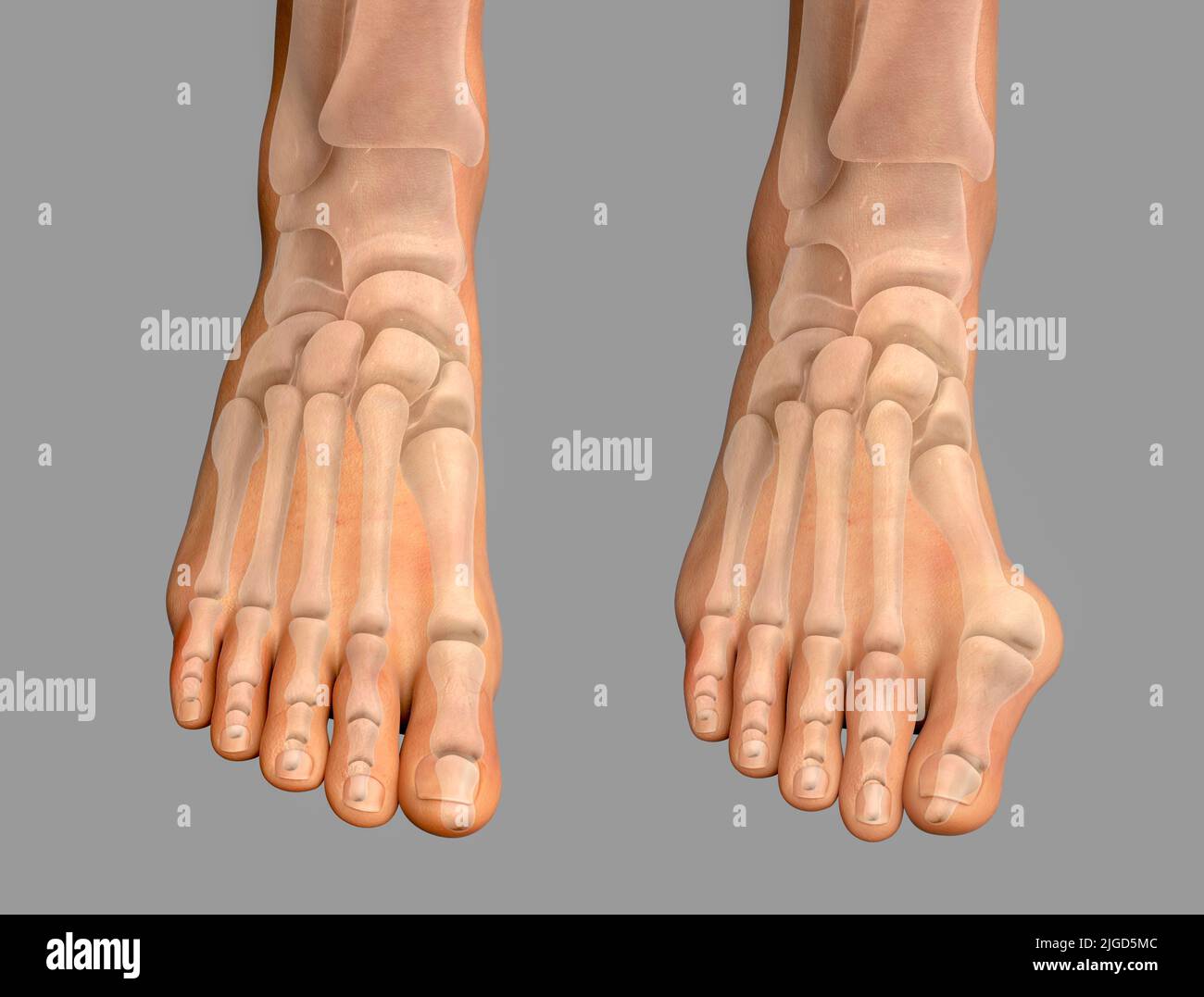 Deformed toe bones hi-res stock photography and images - Alamy
