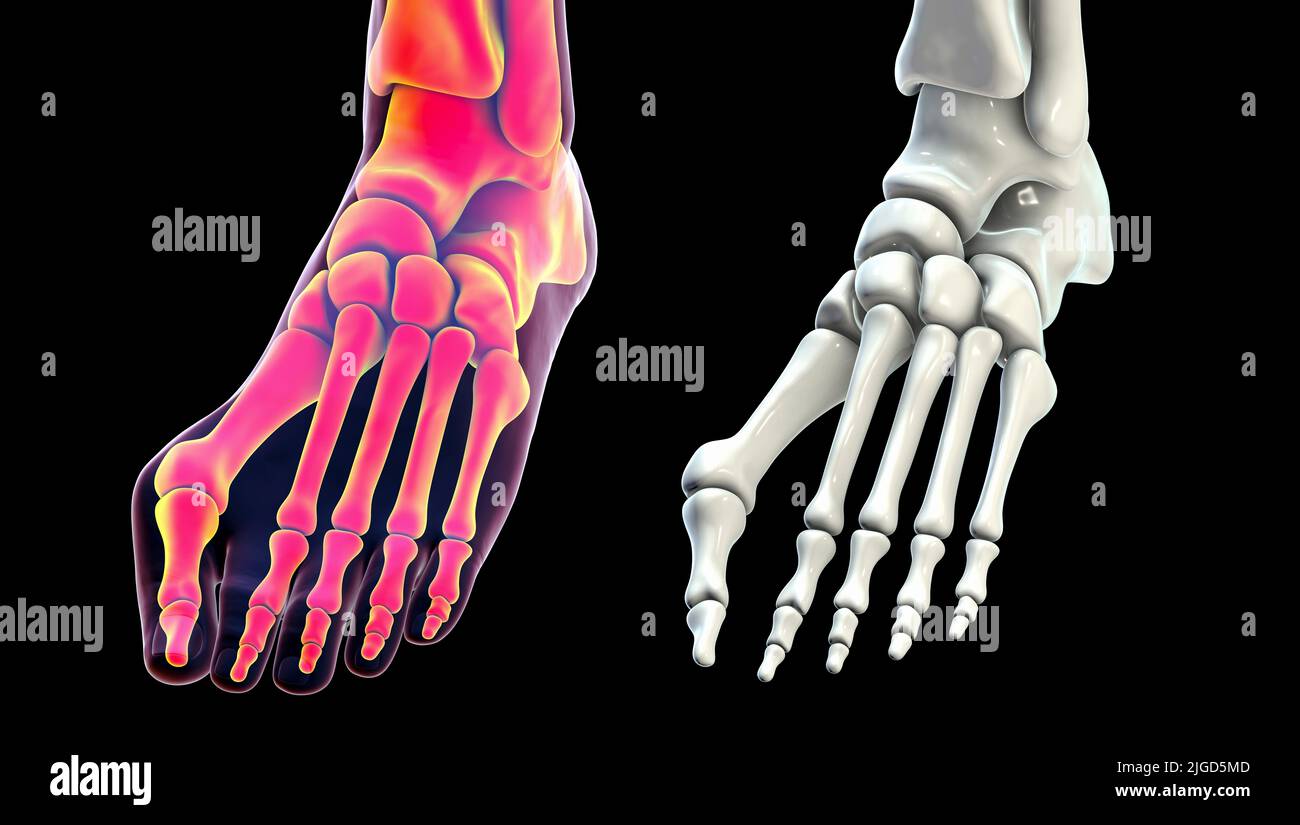 Bone deformities hi-res stock photography and images - Alamy