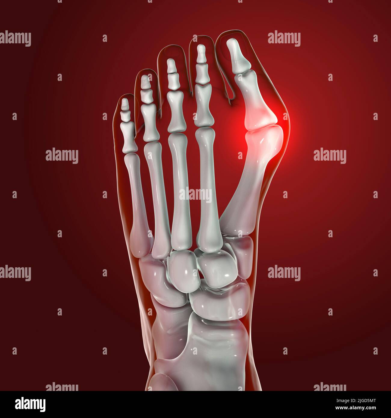 Deformed toe bones hi-res stock photography and images - Alamy