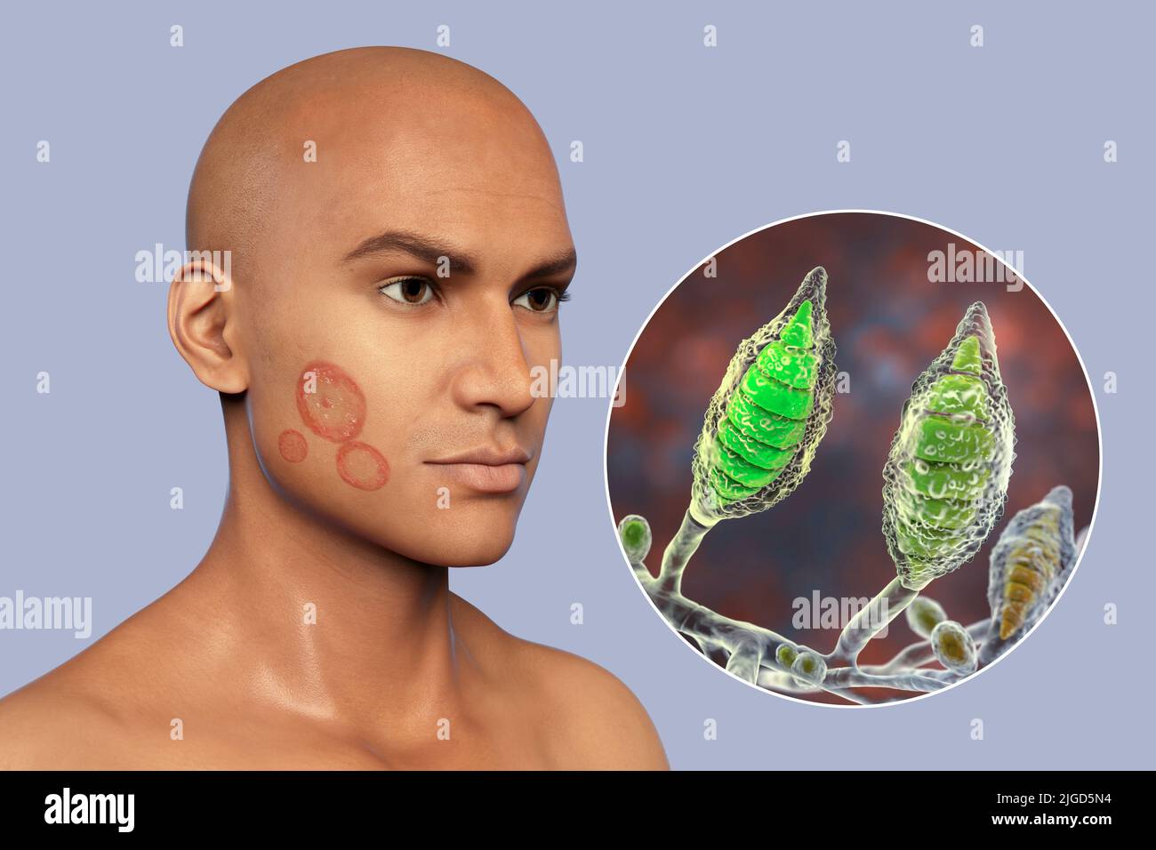 Face ringworm hi-res stock photography and images - Alamy