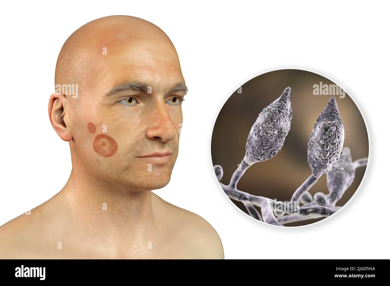 Face ringworm hi-res stock photography and images - Alamy