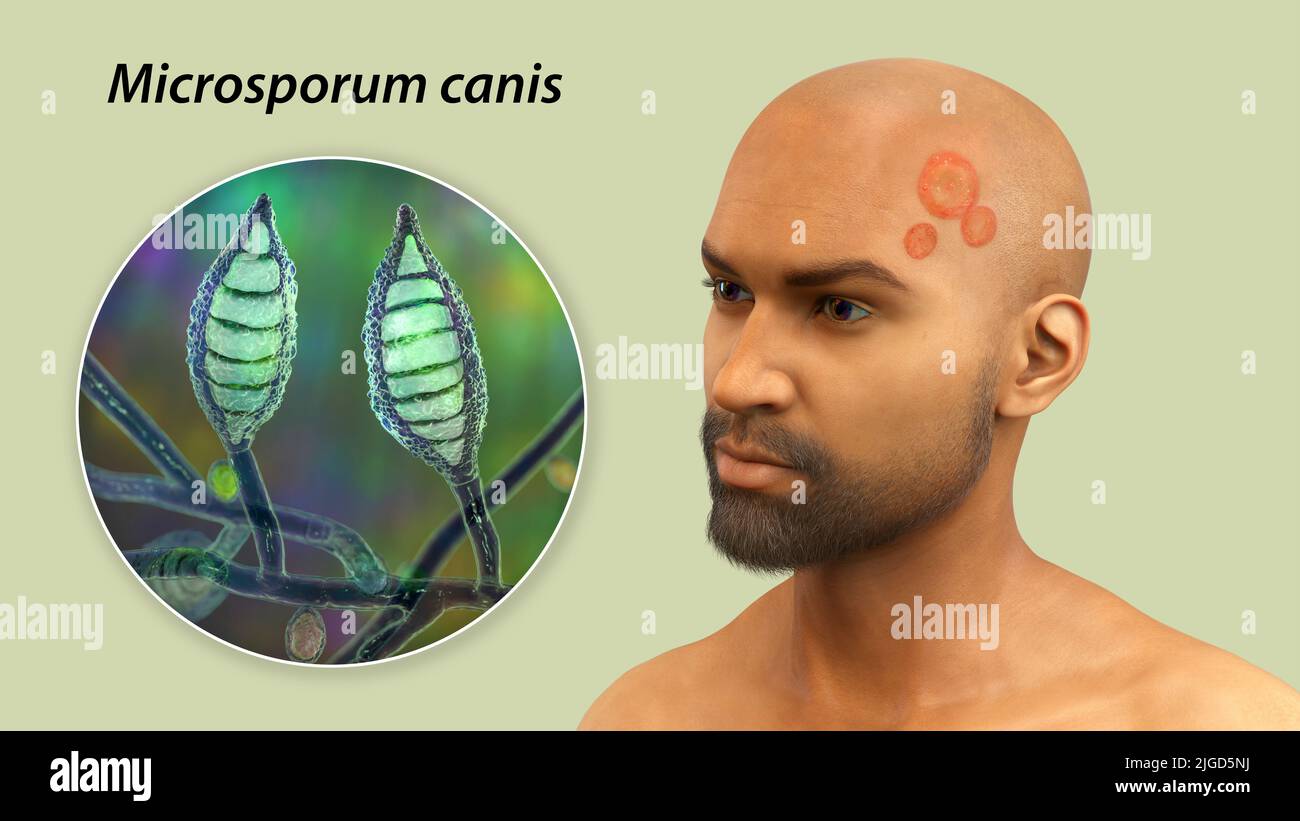Face ringworm hi-res stock photography and images - Alamy