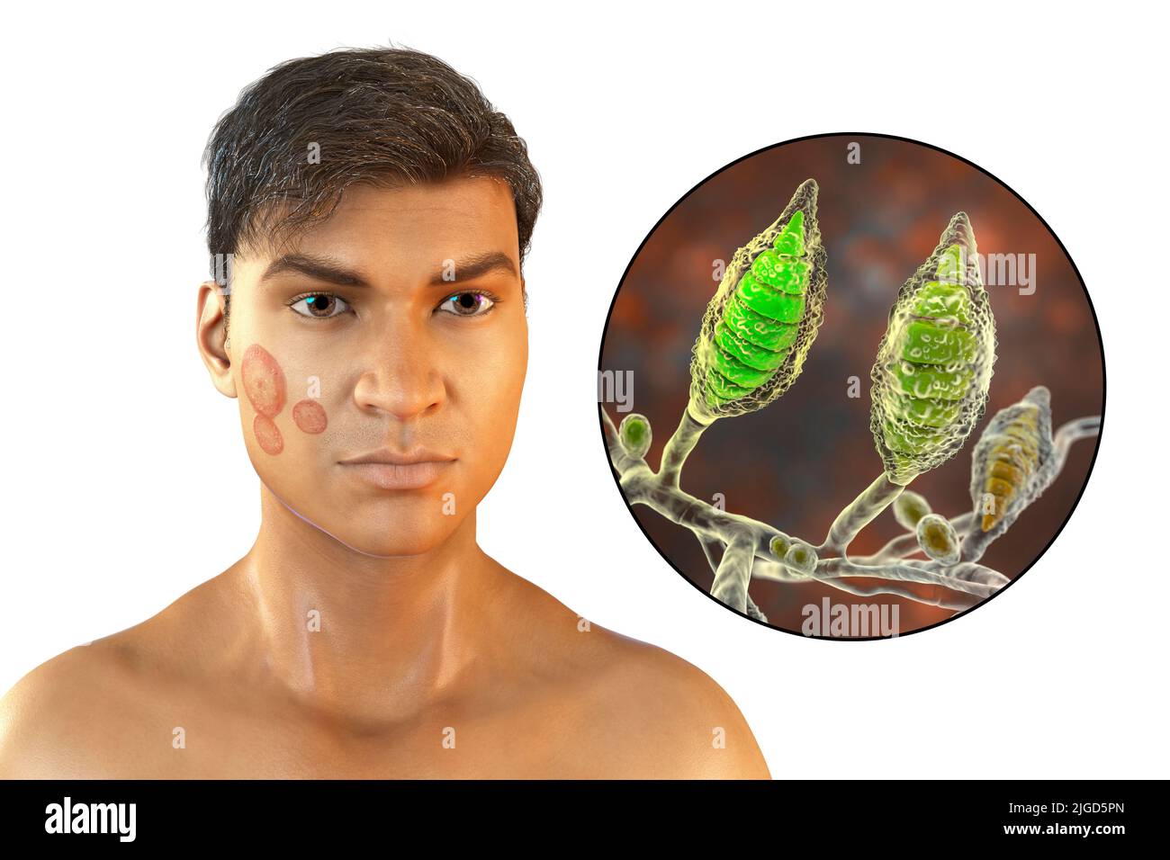 Dermatophytosis ringworm hi-res stock photography and images - Alamy