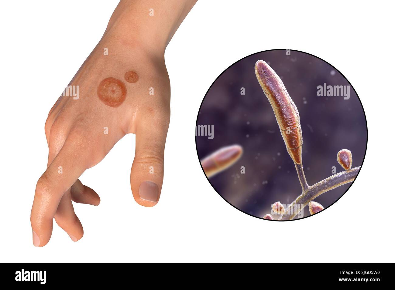 Ringworm fungal infection hand hi-res stock photography and images - Alamy