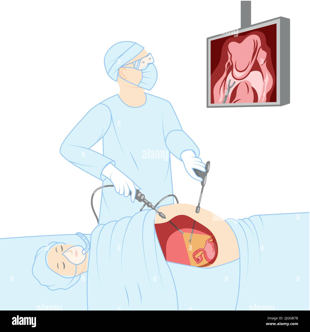 Laparoscopy keyhole surgery doctor with a patient surgical procedure ...