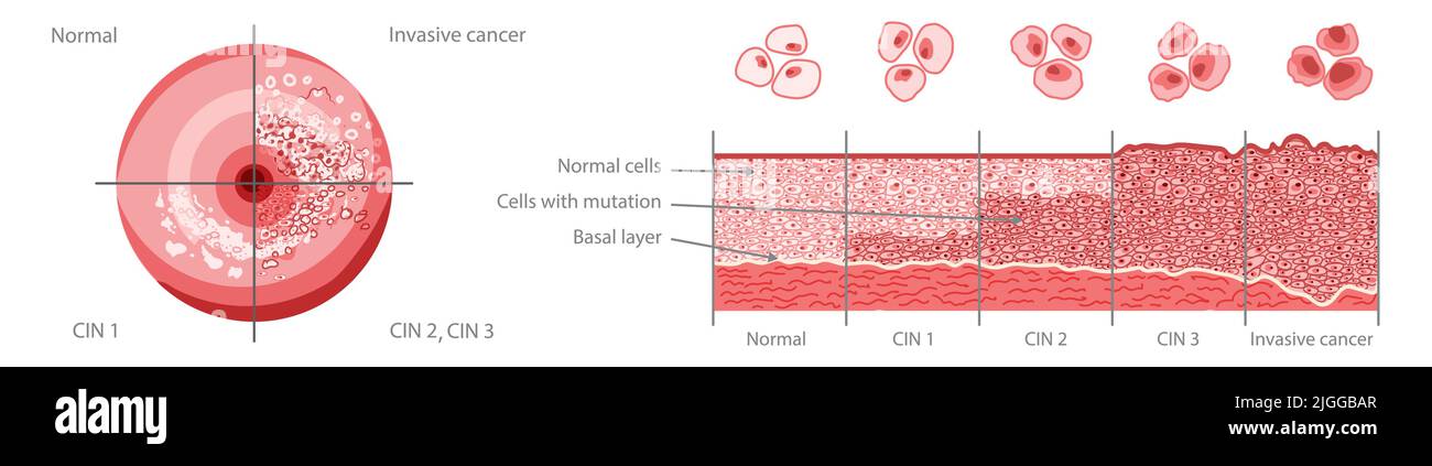 Set of Cervical cancer Dysplasia stages infographic Female reproductive ...