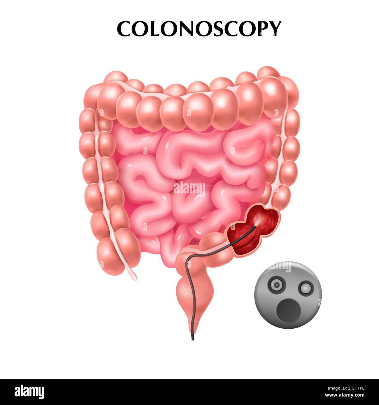 Colonoscopy procedure colored poster with intestine anatomy and ...