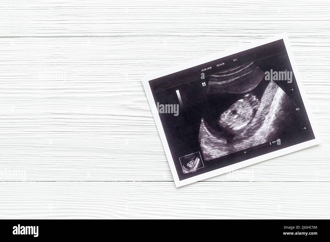 Prenatal ultrasound screening of unborn baby. Pregnancy background ...