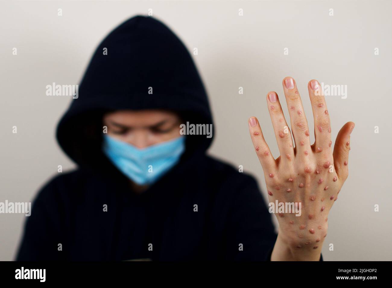 Woman with monkeypox viral rash on hand Stock Photo - Alamy