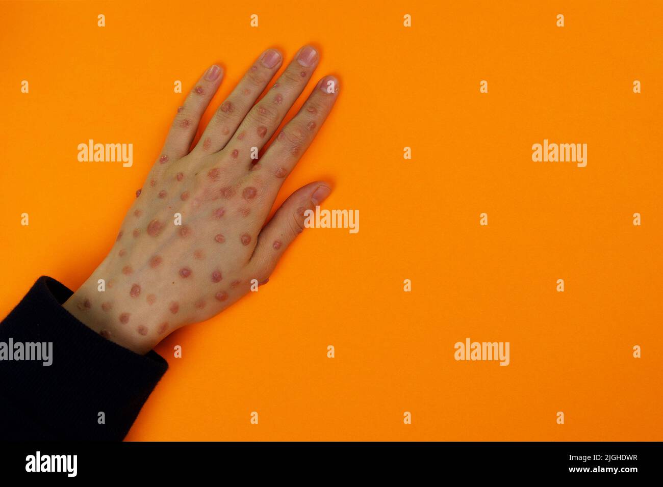 Hand with infected skin on orange background Stock Photo - Alamy