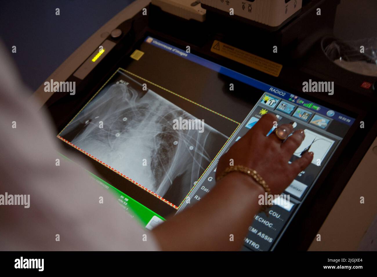 X-ray of a patient s lungs, Briancon, France on July 086 2022. Three ...