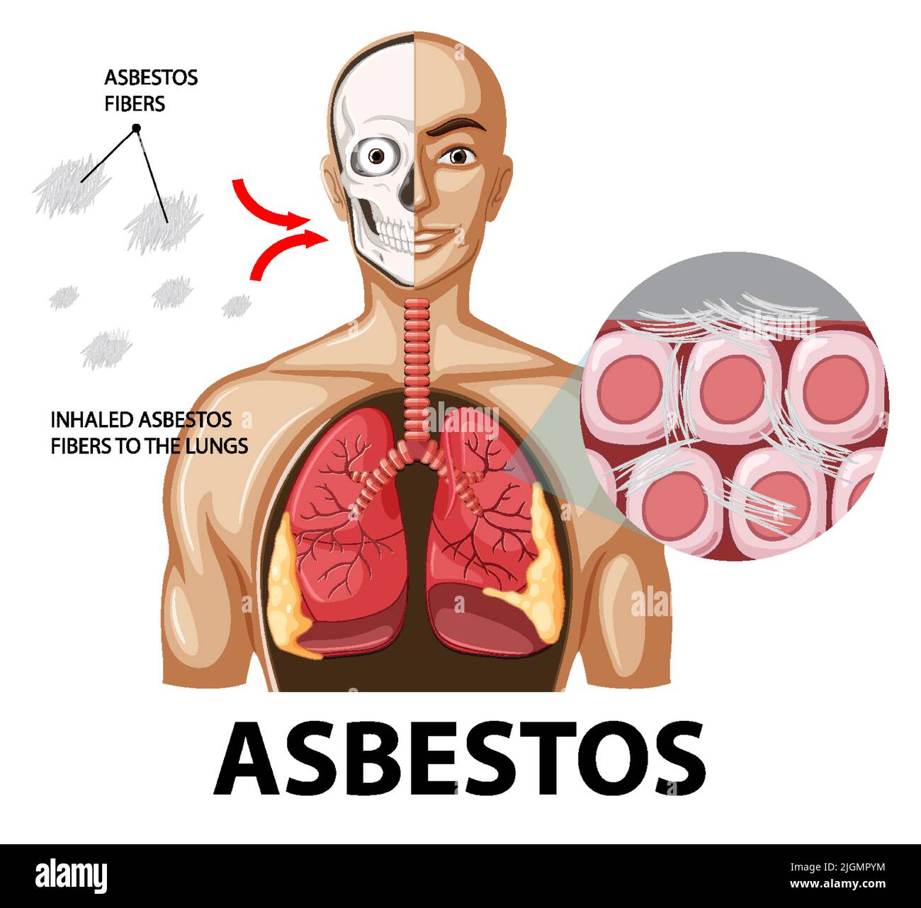 Asbestos in lungs hi-res stock photography and images - Alamy