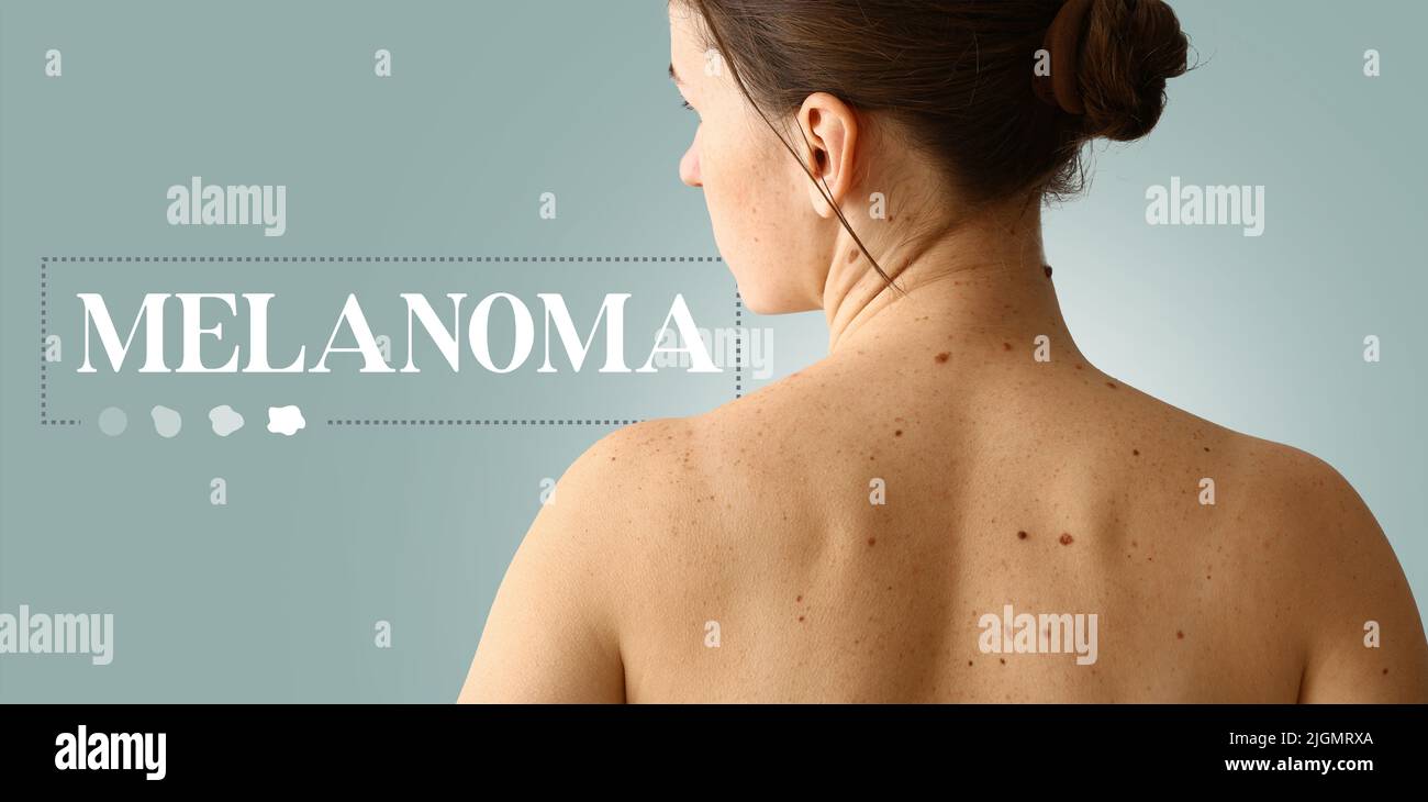 Young woman with moles and word MELANOMA on grey background Stock Photo ...