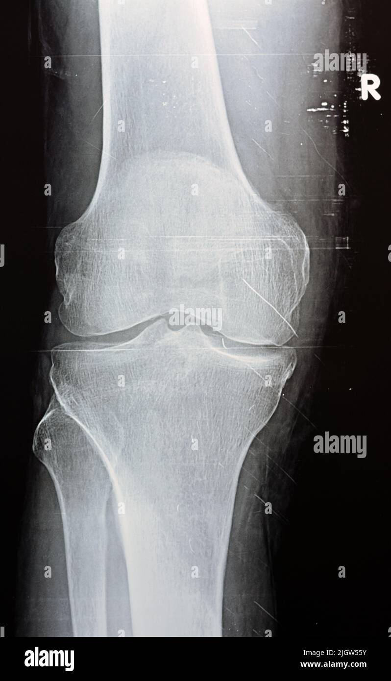Plain X ray of the right knee shows apparent joint osteoarthritis ...