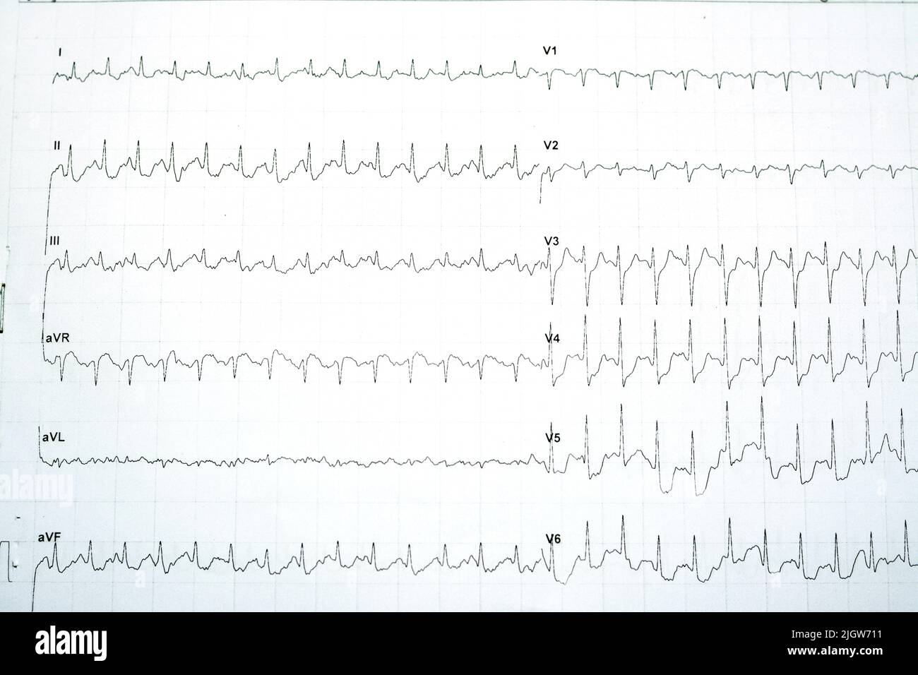 A positive stress induced myocardial ischemia with significant ...