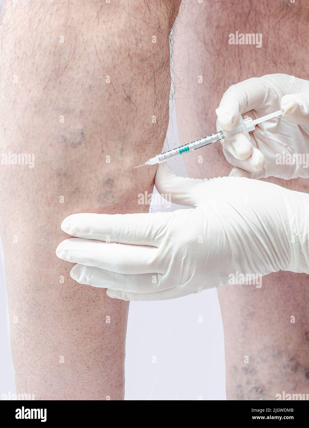 Varicose veins in legs hi-res stock photography and images - Alamy