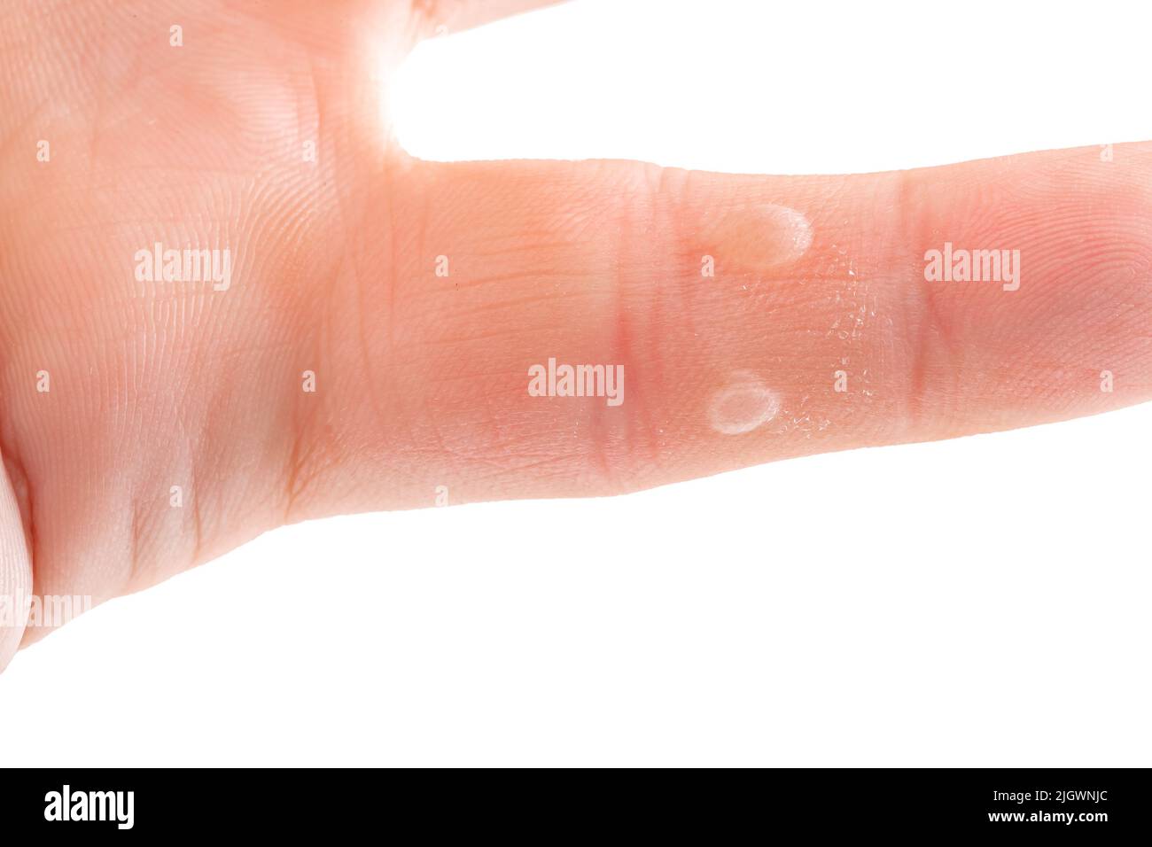 On hand finger there are blisters callus. Medical trauma with dry skin ...