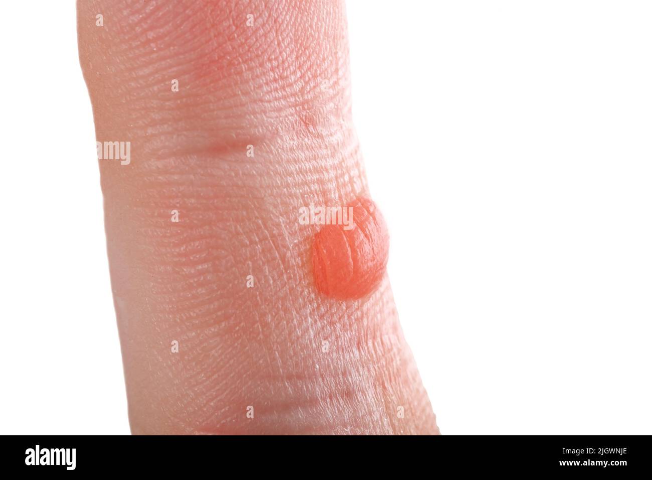 On finger there is redness blister, inflammation callus. Workers hand ...
