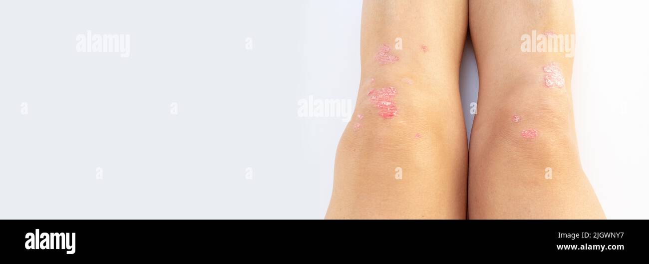 Psoriatic Arthritis With Skin Psoriasis On A Womans Knees Synovial Fluid In A Patient With