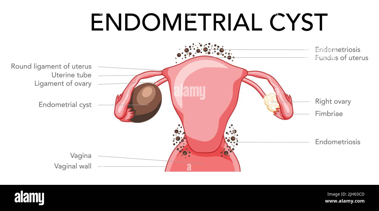 Set of Ovarian endometriomas chocolate cysts Female reproductive system uterus problem diagram ...