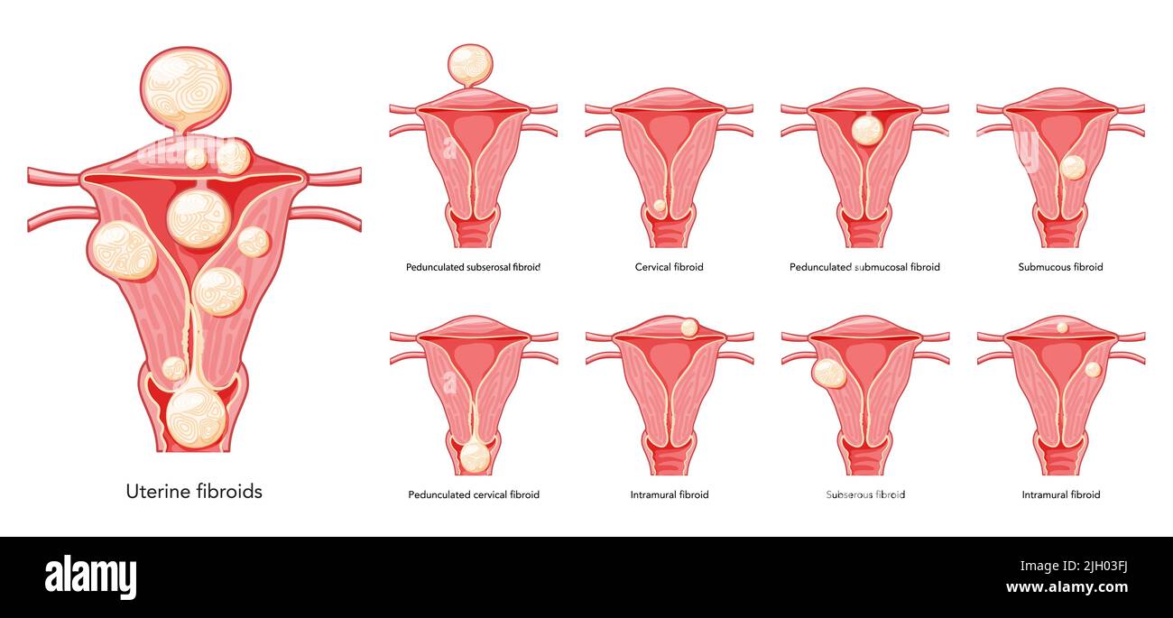 Set Of Uterine Fibroids Female Leiomyomas Reproductive System Uterus