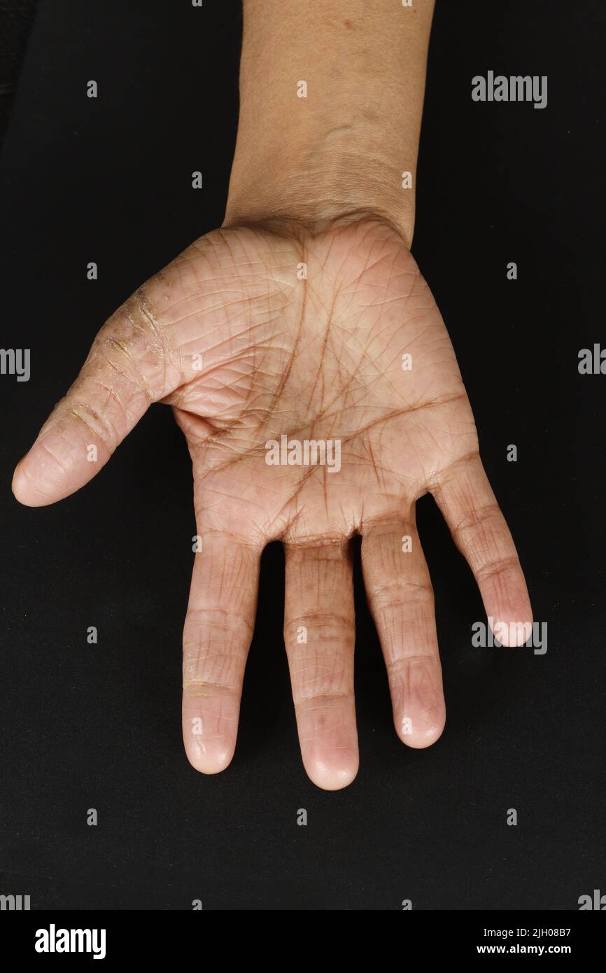Hyperlinear palm in atopic dermatitis Stock Photo - Alamy