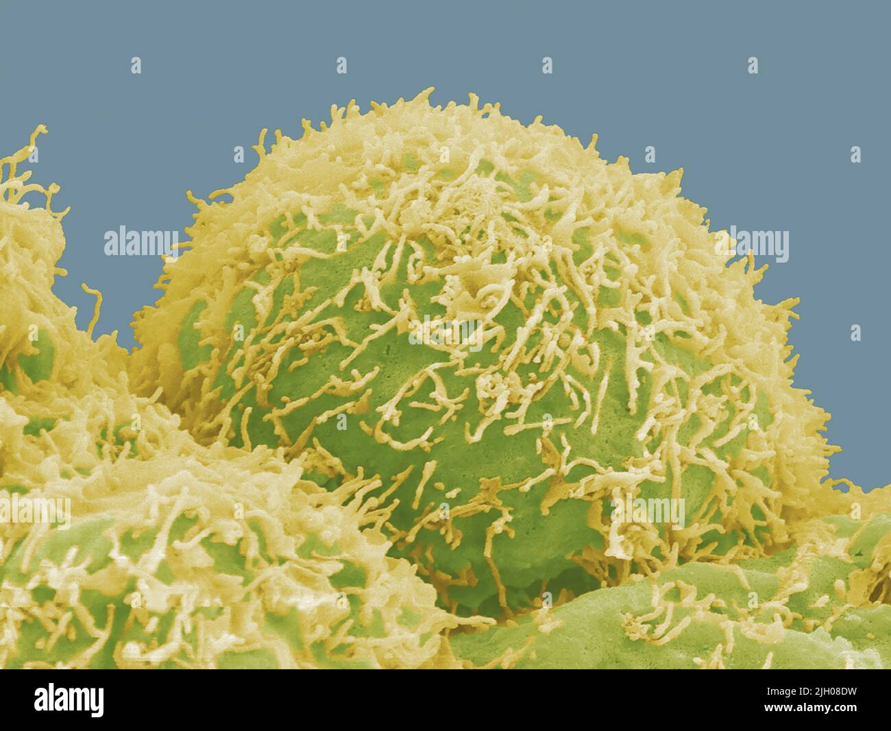 Prostate cancer cells, SEM Stock Photo - Alamy