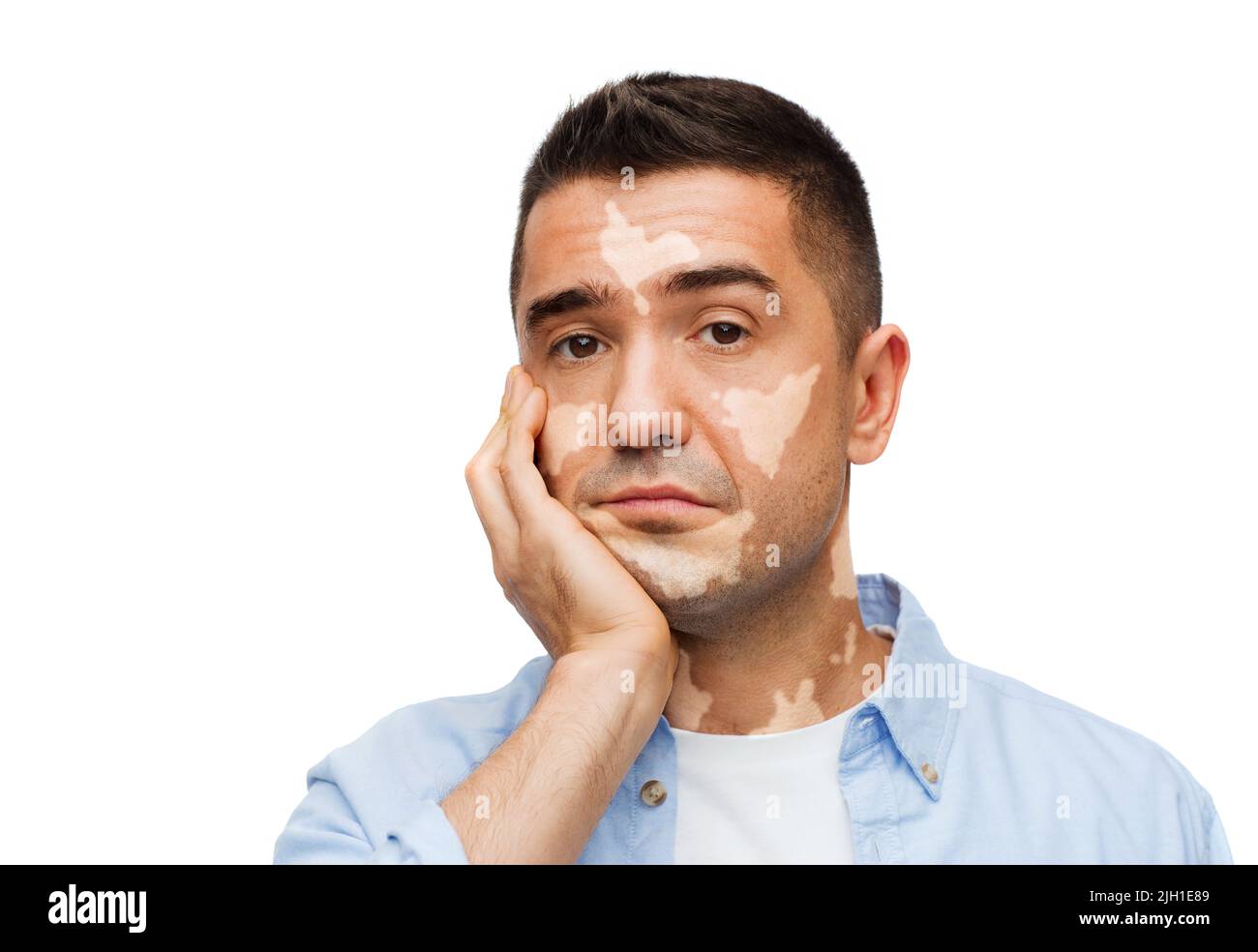 Vitiligo spot hi-res stock photography and images - Alamy