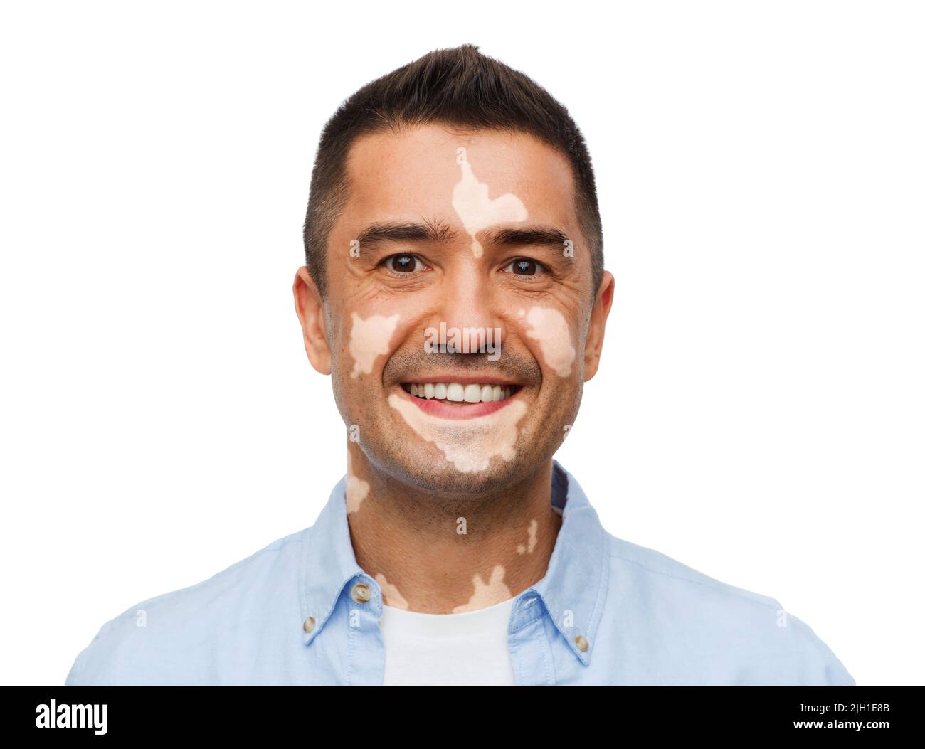 happy smiling man with vitiligo Stock Photo - Alamy