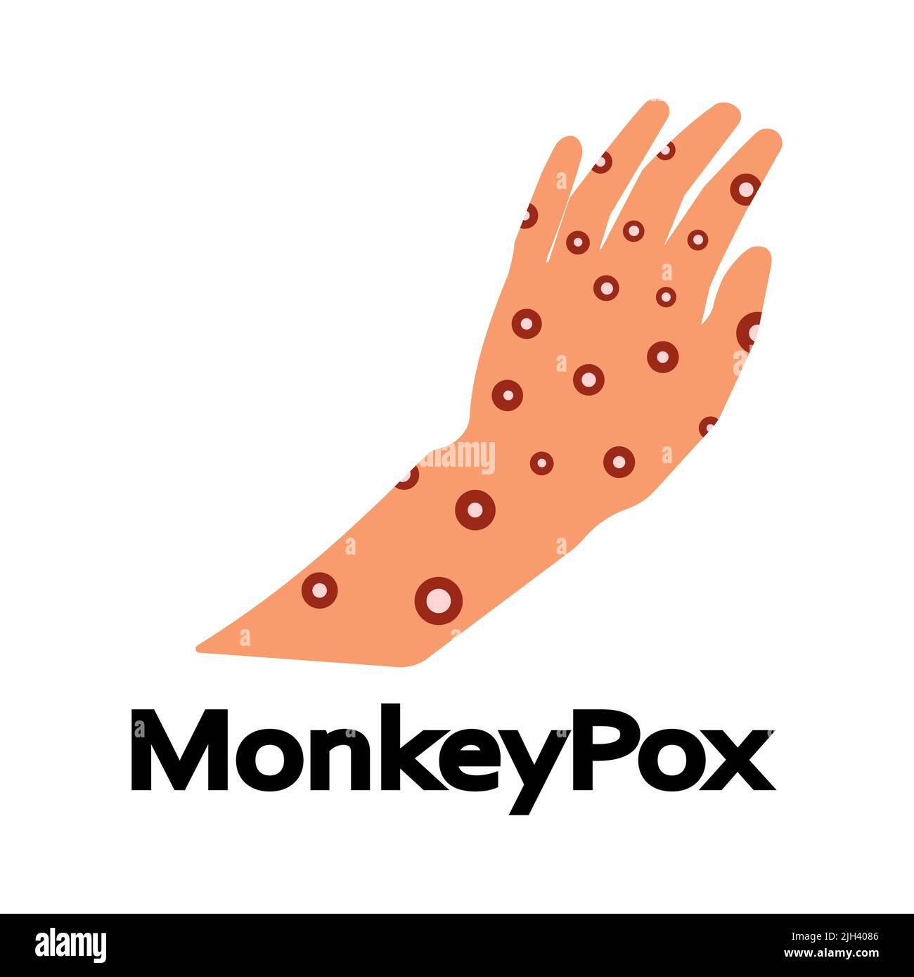 Monkeypox virus. Eruption on the body. Monkey Pox virus disease ...