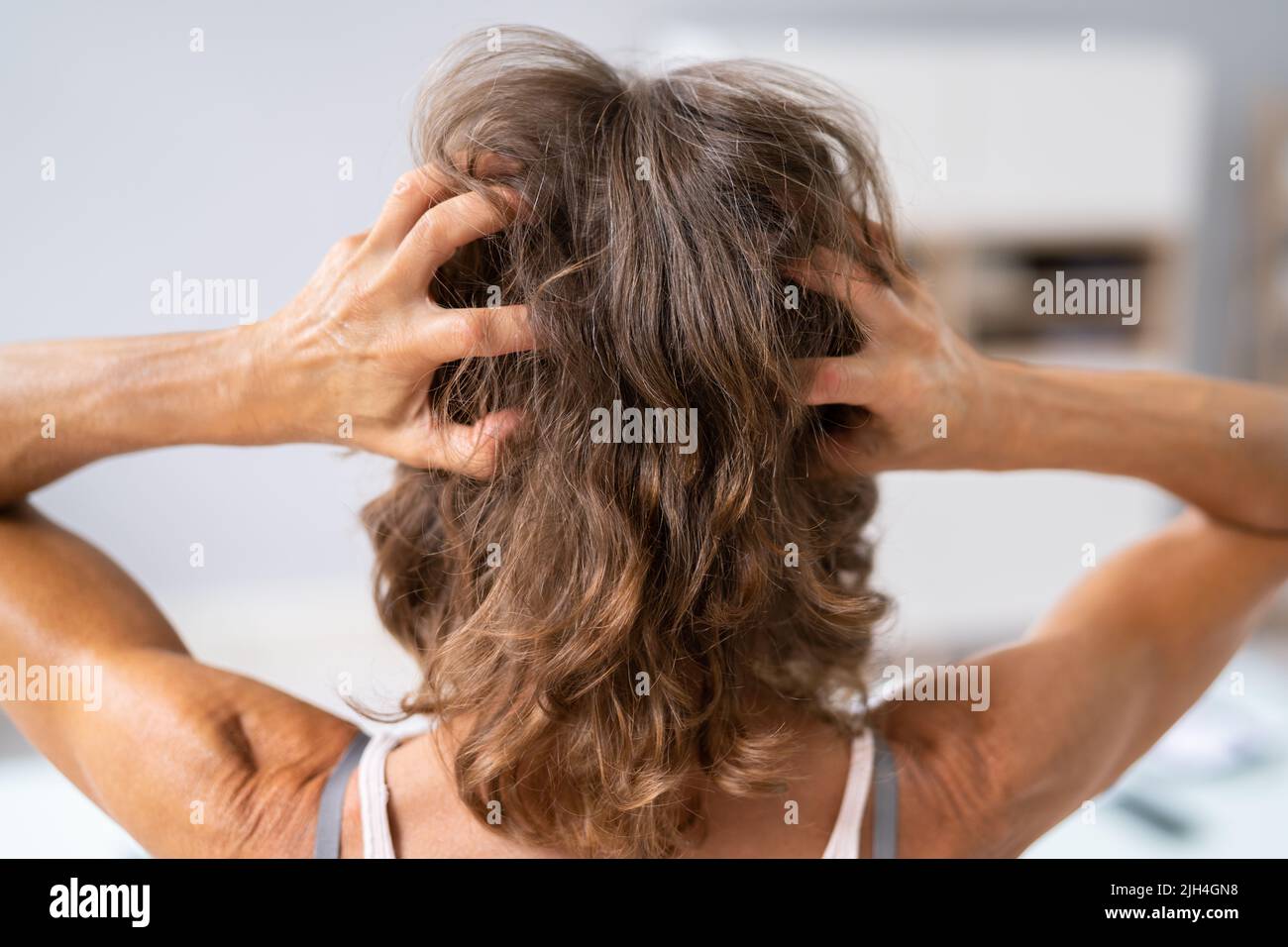 Itching Dry Head Scalp And Long Hair With Dandruff Stock Photo - Alamy