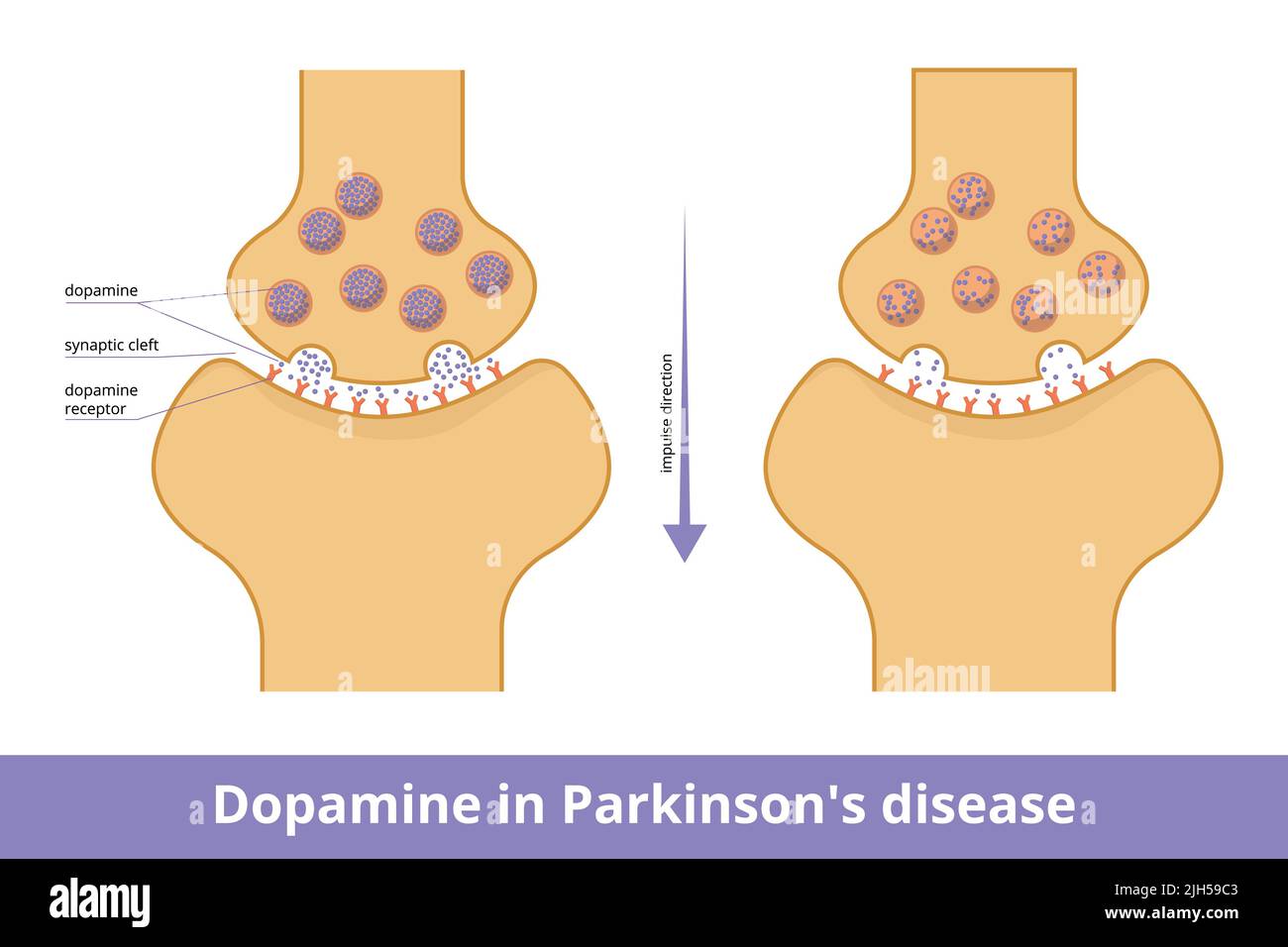 Dopamine in Parkinson's disease. Visualization of dopamine production ...