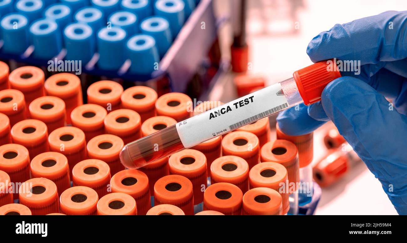 ANCA test tube with blood sample in infection lab Stock Photo - Alamy