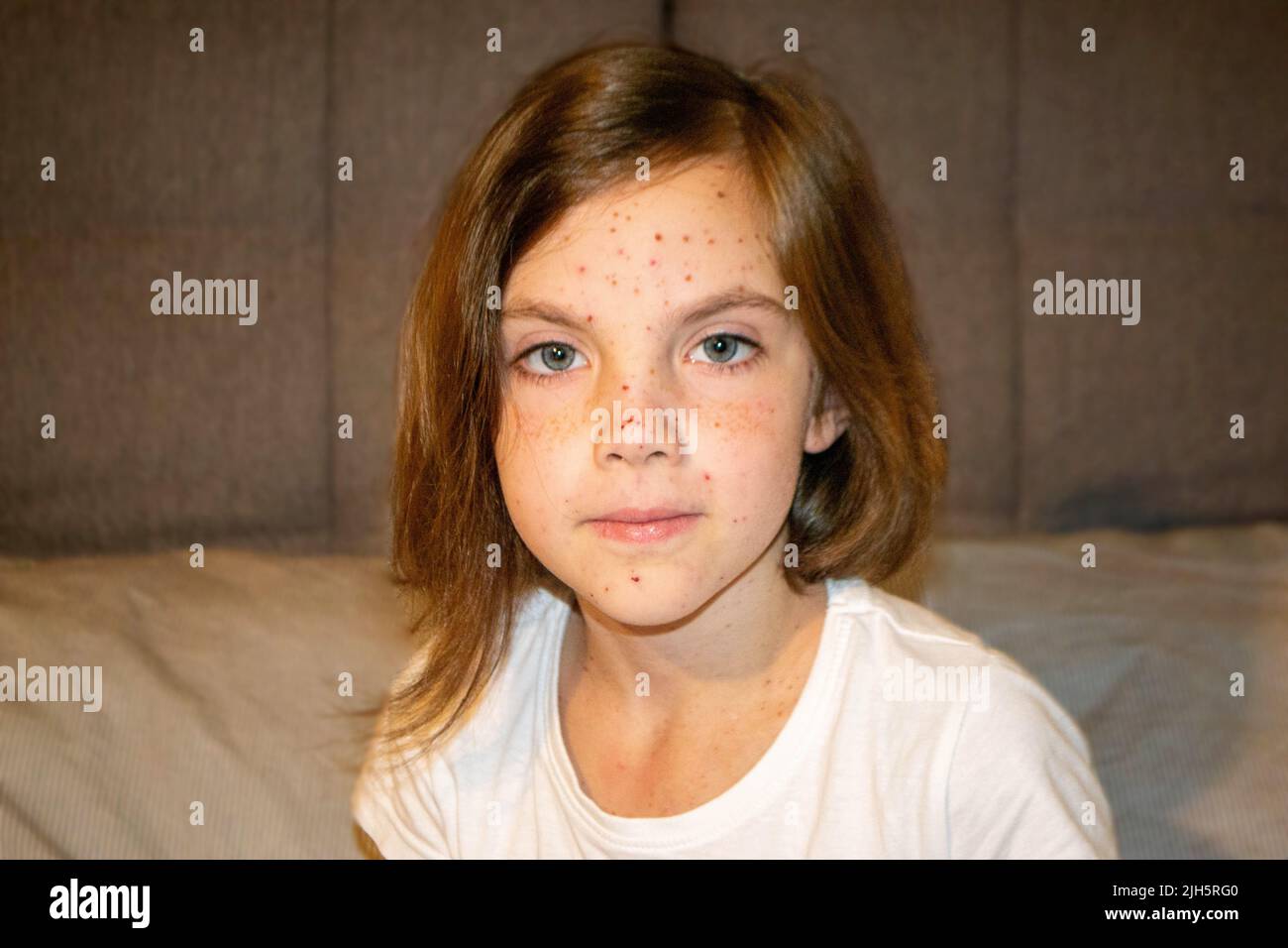 Natural vaccination. Contagious disease. Sick child with chickenpox ...