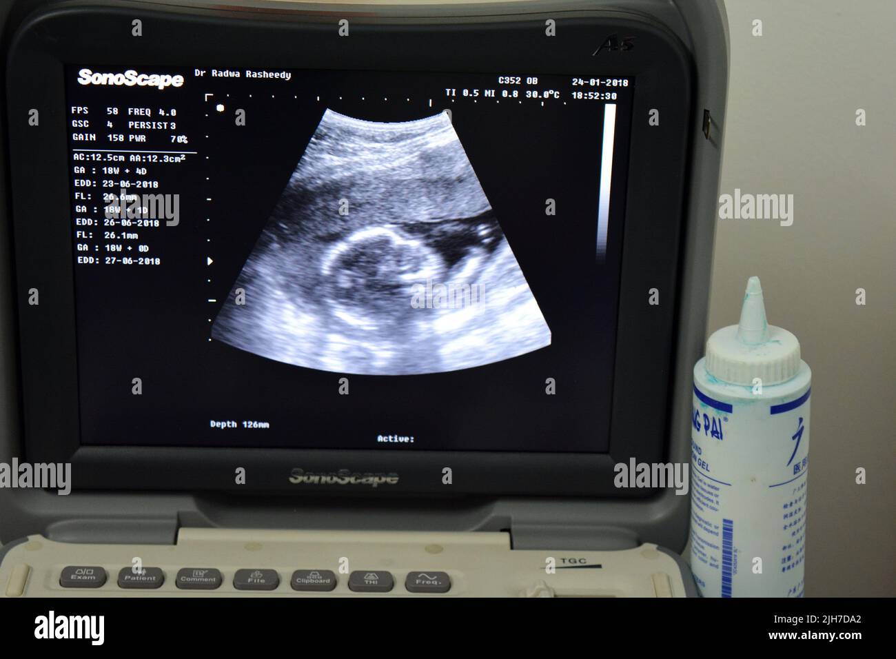 24 Weeks Pregnant Scan
